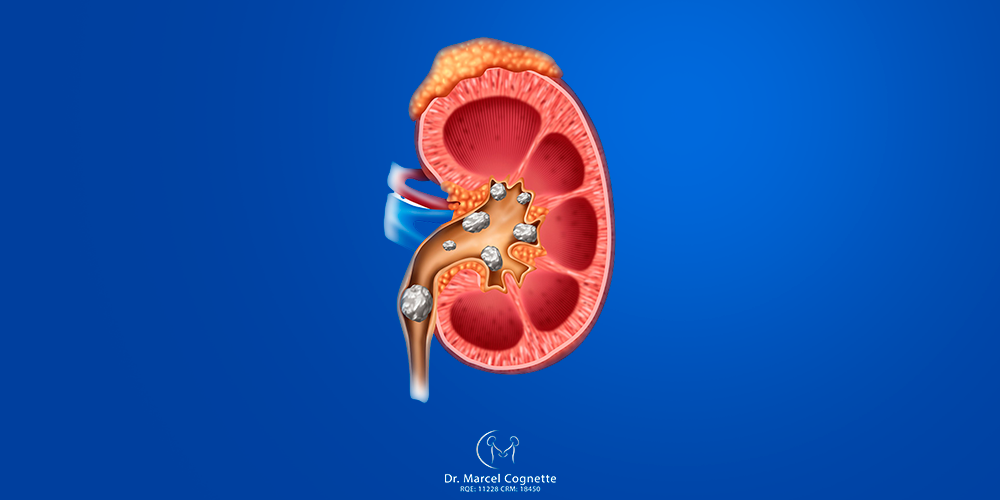 Tipos de pedras nos rins e como tratar – Dr Marcel Urologista
